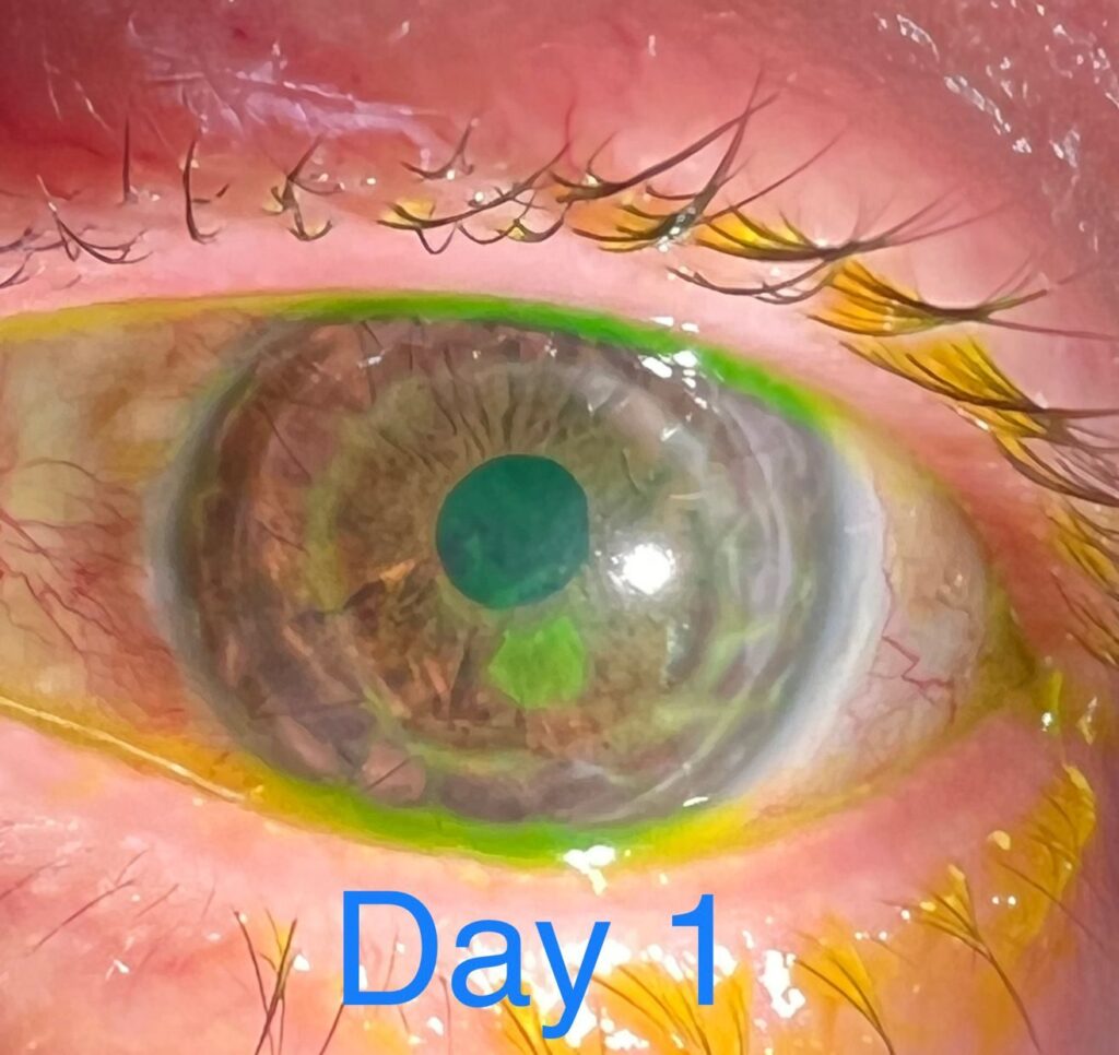 Doctor uses Apple iPhone 13 Pro Max Macro camera mode to check eyes ...